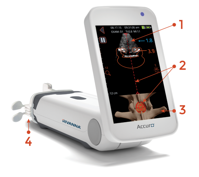 Automatic Epidural Location and Depth - Rivanna Medical