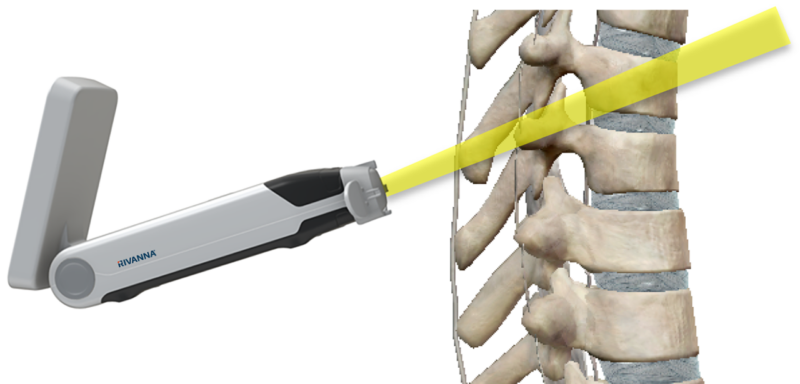 A Paramedian Lumbar Epidural with Accuro - Rivanna Medical