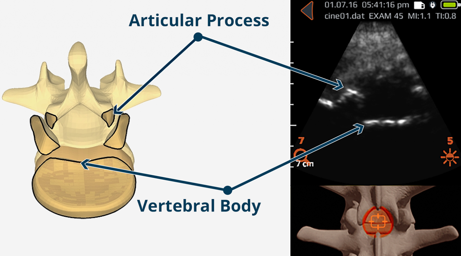 Neuraxial Sonoanatomy — Refresher - Rivanna Medical