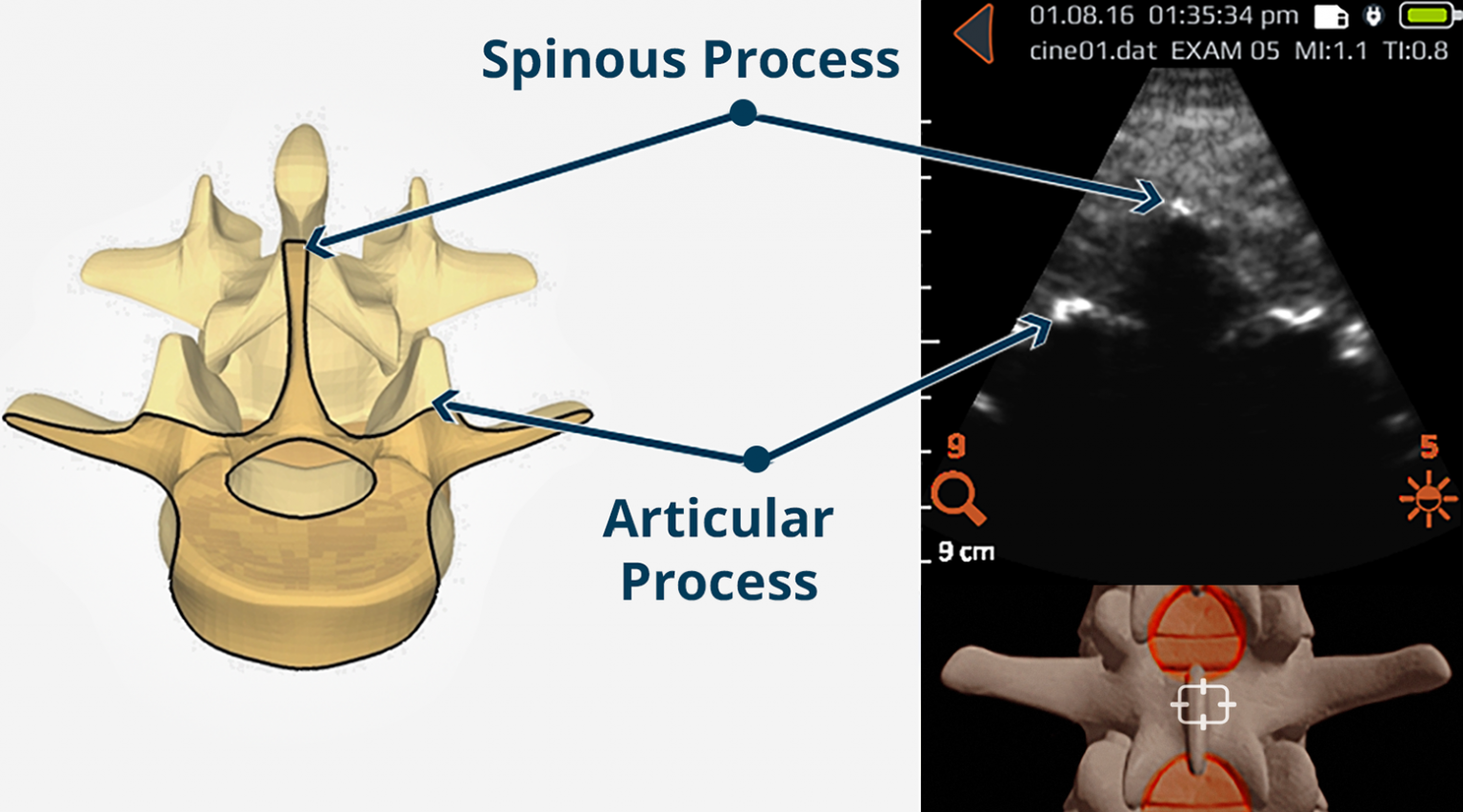 Neuraxial Sonoanatomy — Refresher - Rivanna Medical