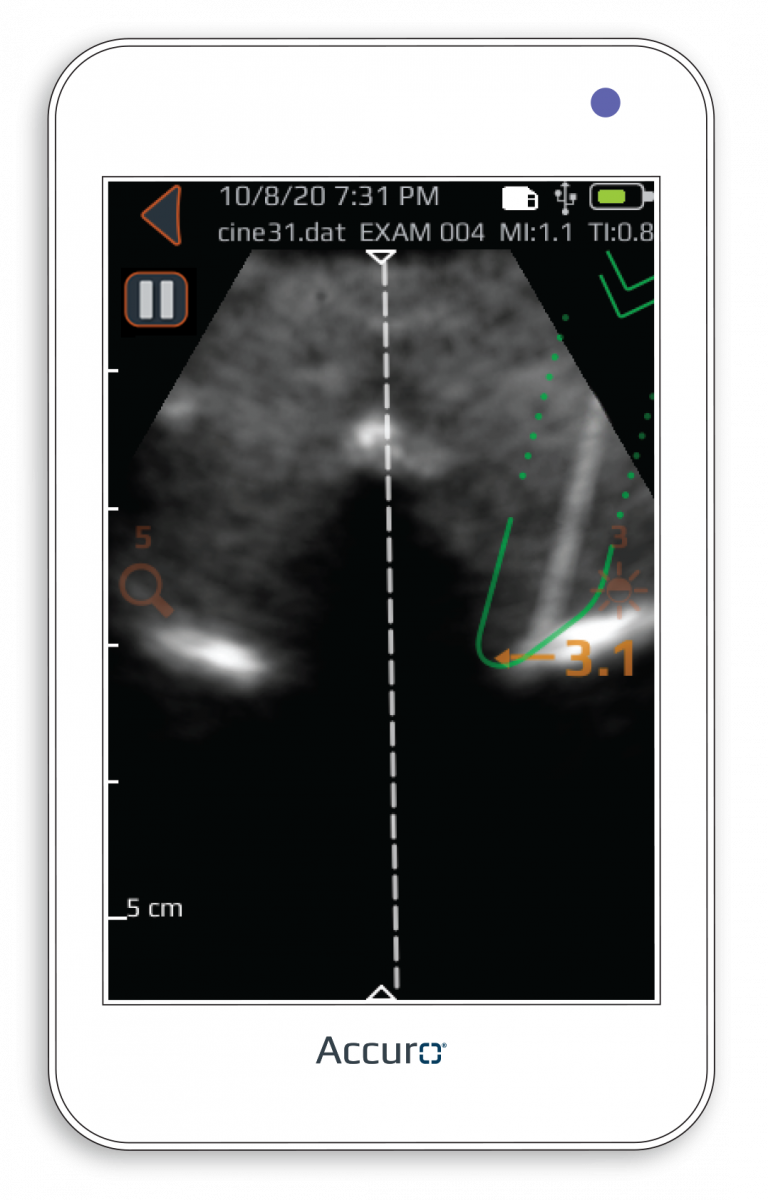 A Paramedian Lumbar Epidural with Accuro - Rivanna Medical